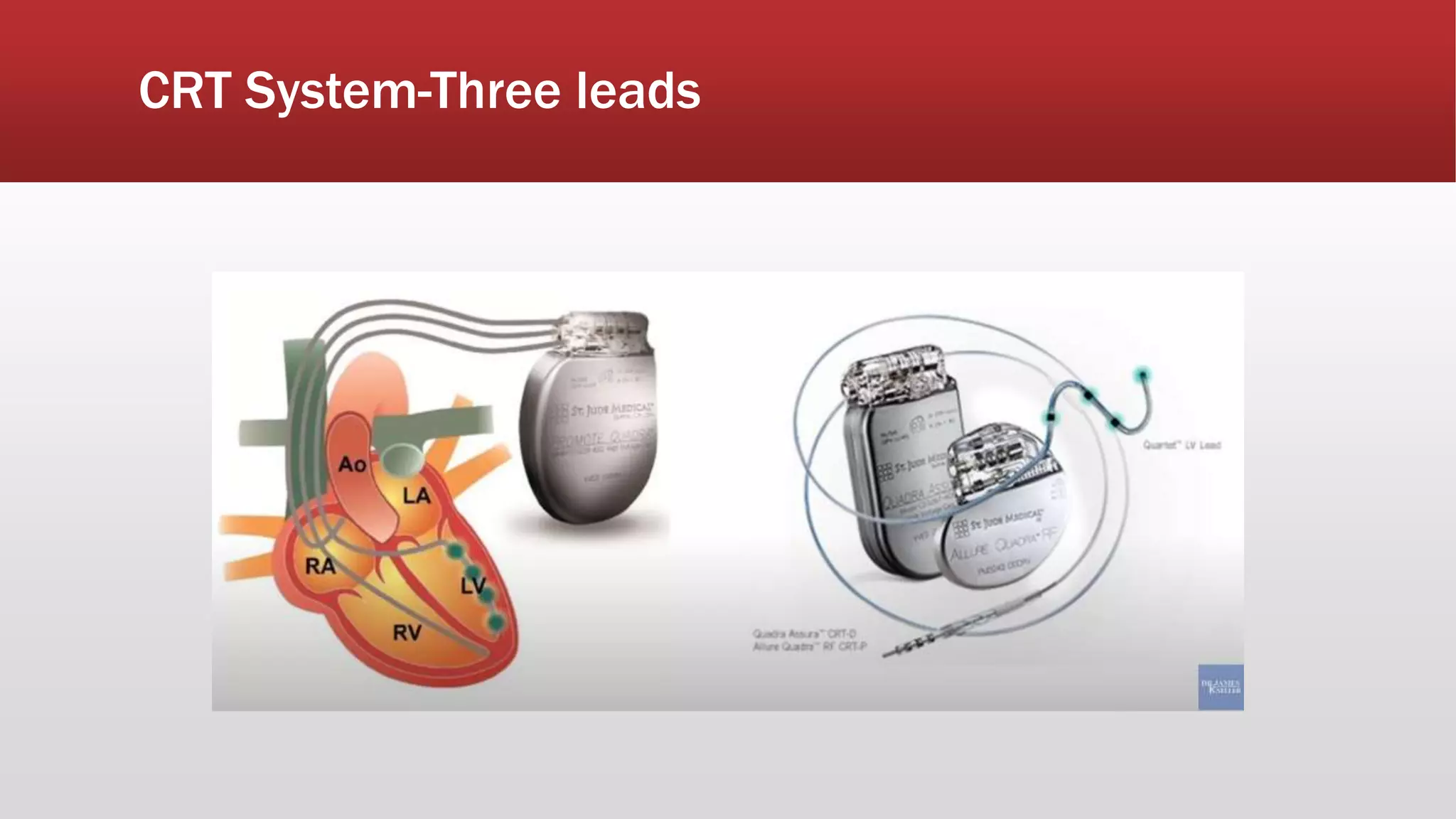 Cardiac Resynchronization therapy.pptx
