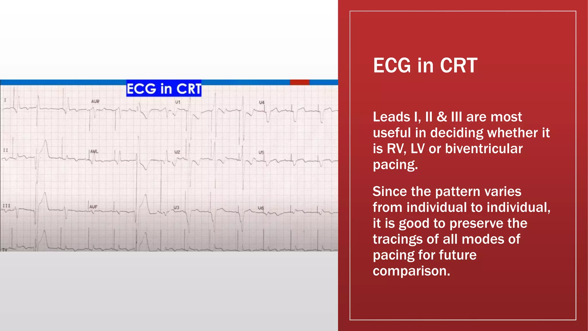 Cardiac Resynchronization therapy.pptx