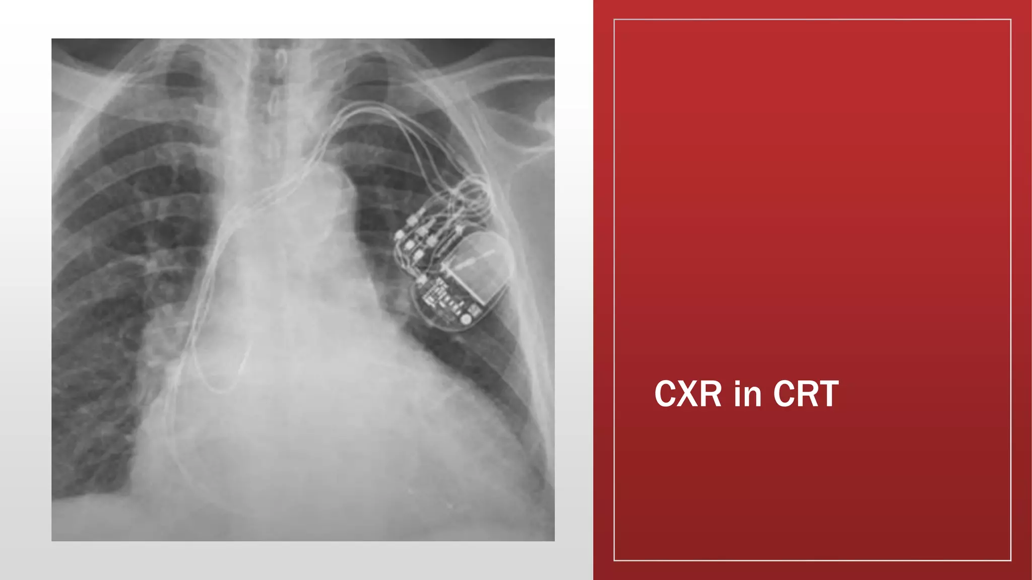 Cardiac Resynchronization therapy.pptx