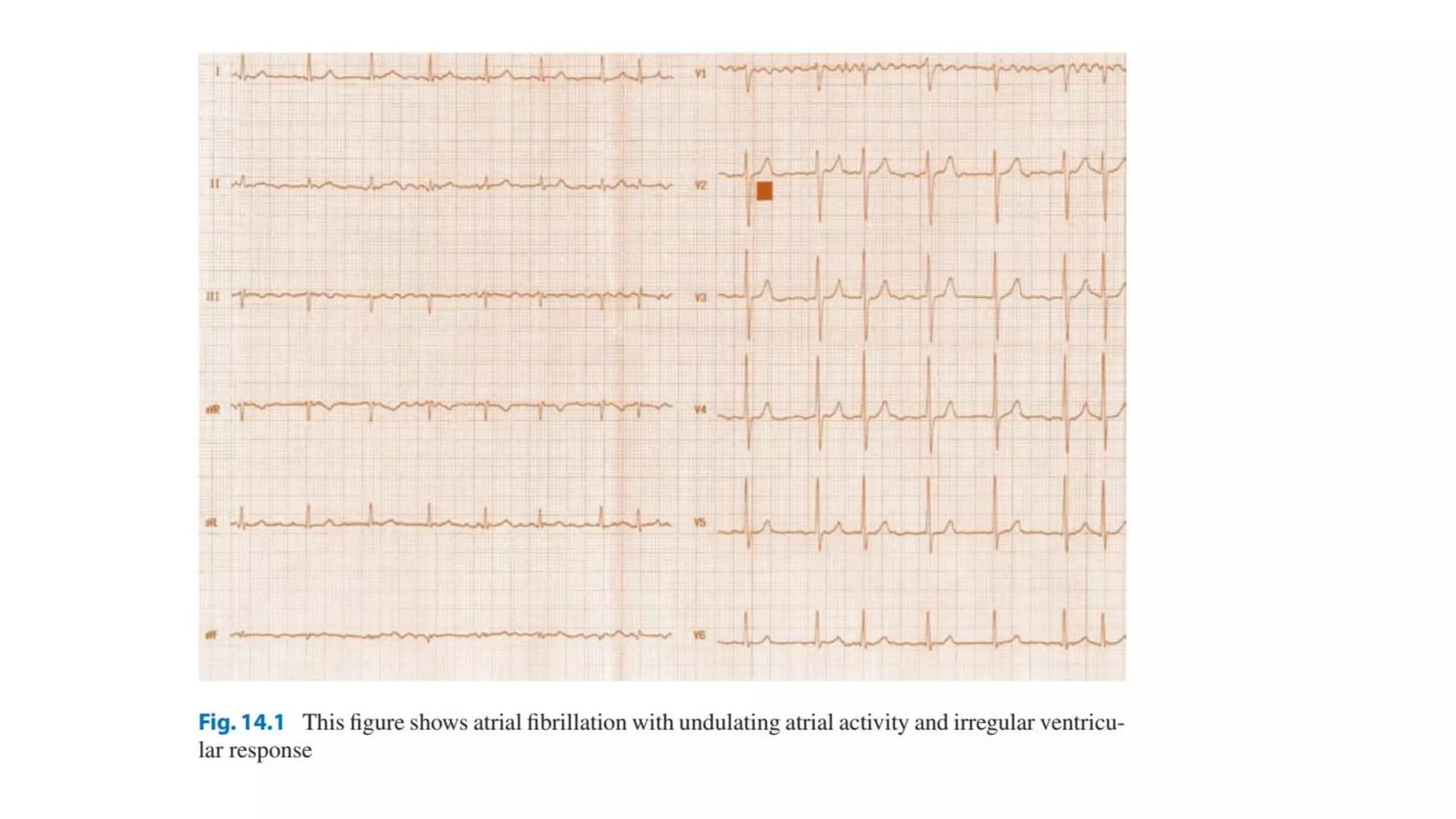 Cardiac Rhythm Disturbance and Temporary Pacemakers.pdf