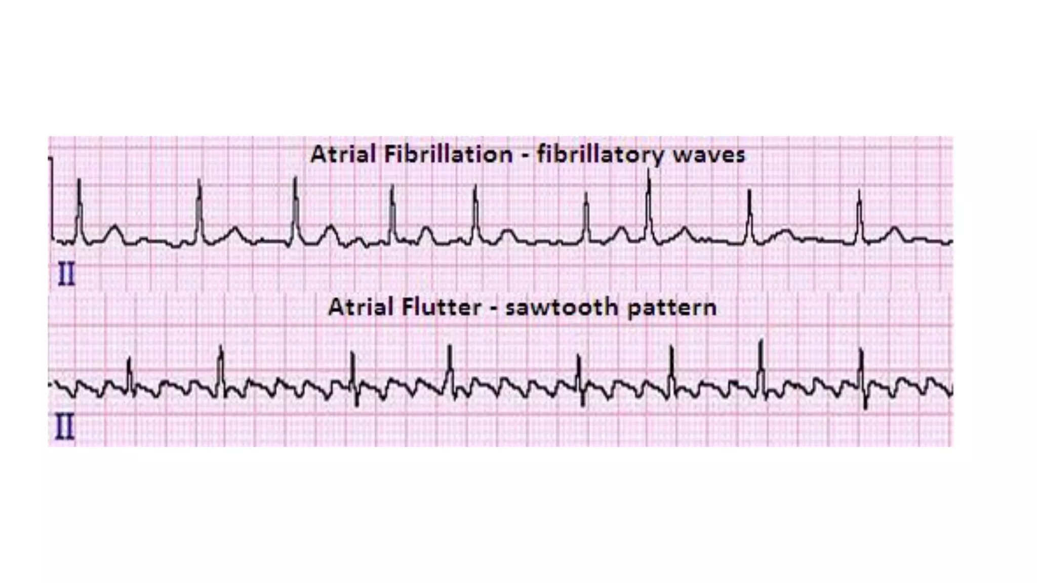 Cardiac Rhythm Disturbance and Temporary Pacemakers.pdf