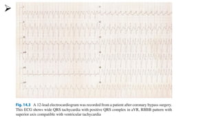 Cardiac Rhythm Disturbance and Temporary Pacemakers.pdf