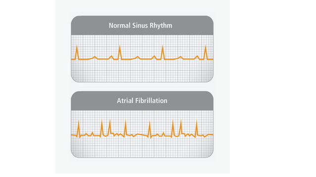 Cardiac Rhythm Disturbance and Temporary Pacemakers.pdf