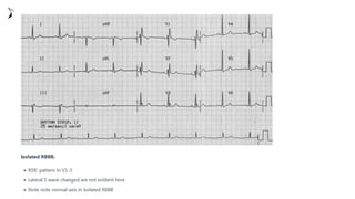 Cardiac Rhythm Disturbance and Temporary Pacemakers.pdf