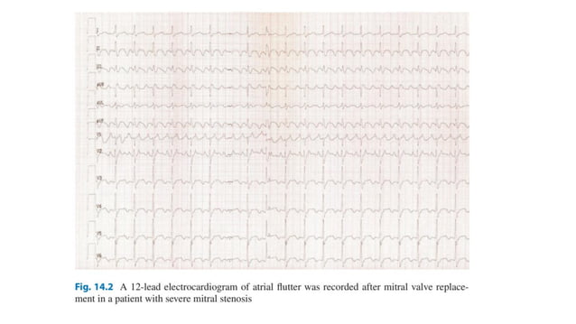 Cardiac Rhythm Disturbance and Temporary Pacemakers.pdf