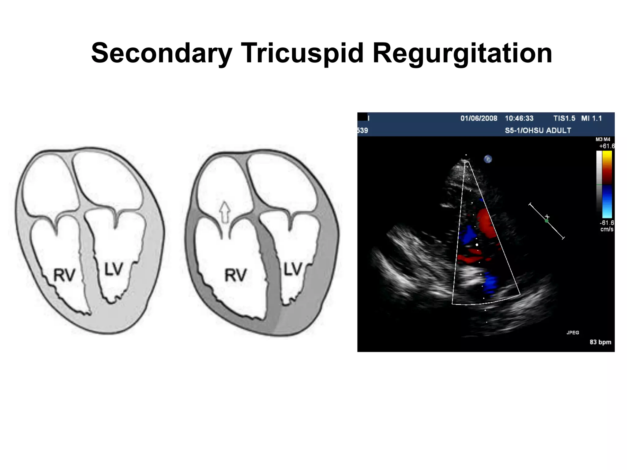 Cardiovascular Manifestations, Systemic Sclerosis by Dr. Jonathan R ...