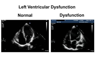 Cardiovascular Manifestations, Systemic Sclerosis by Dr. Jonathan R ...