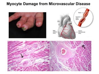 Cardiovascular Manifestations, Systemic Sclerosis by Dr. Jonathan R ...
