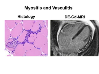 Cardiovascular Manifestations, Systemic Sclerosis by Dr. Jonathan R ...