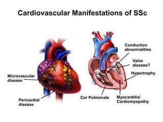 Cardiovascular Manifestations, Systemic Sclerosis by Dr. Jonathan R ...