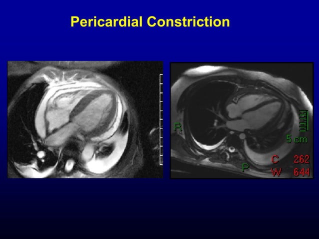 Cardiovascular Manifestations, Systemic Sclerosis by Dr. Jonathan R ...