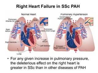 Cardiovascular Manifestations, Systemic Sclerosis by Dr. Jonathan R ...