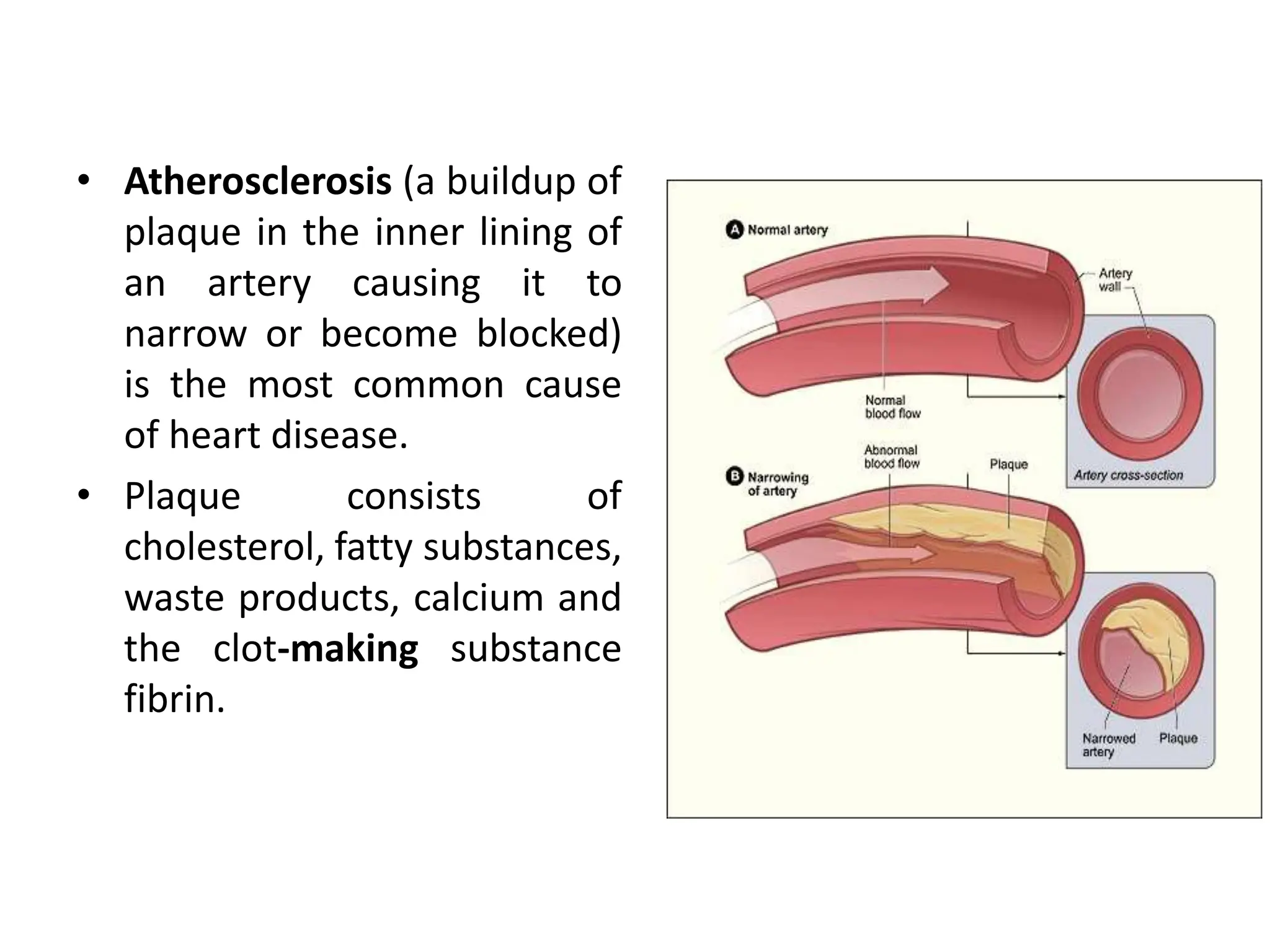 Cardiac Stent,valve,heart, disease, heart failure | PPT