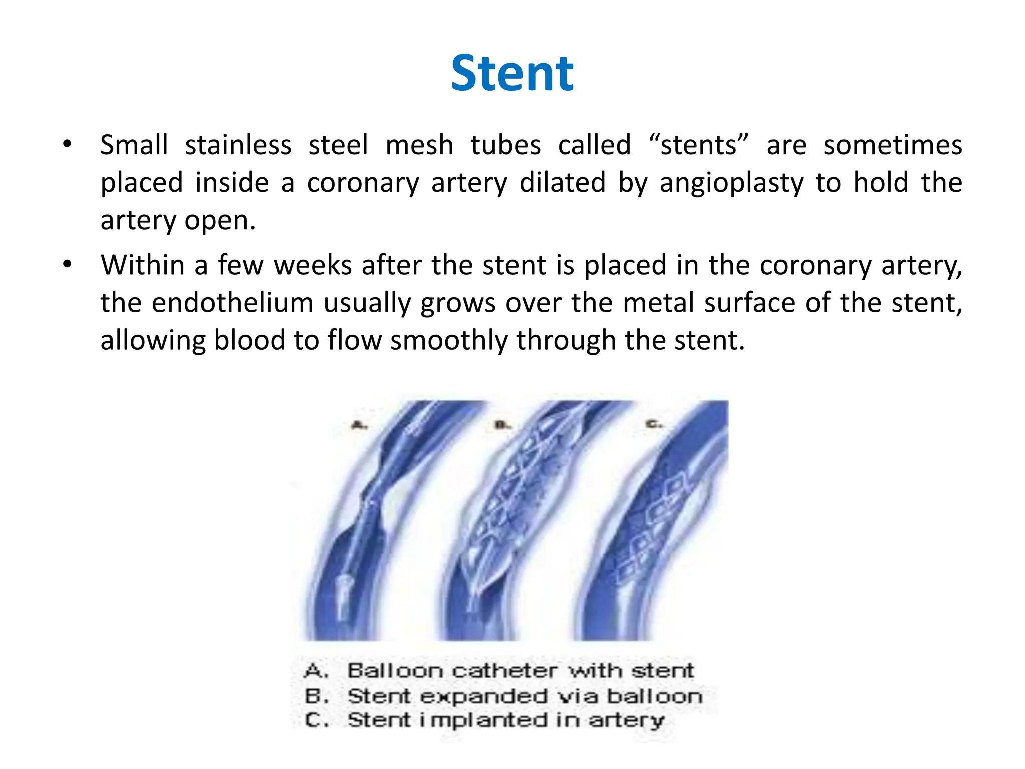 Cardiac Stent,valve,heart, disease, heart failure | PPT