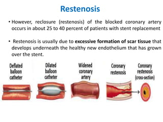 Cardiac Stent,valve,heart, disease, heart failure | PPTX