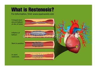 Cardiac Stent,valve,heart, disease, heart failure | PPTX