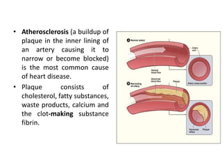 Cardiac Stent,valve,heart, disease, heart failure | PPTX