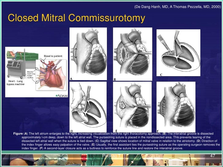 Cardiac surgeries_Padkao T