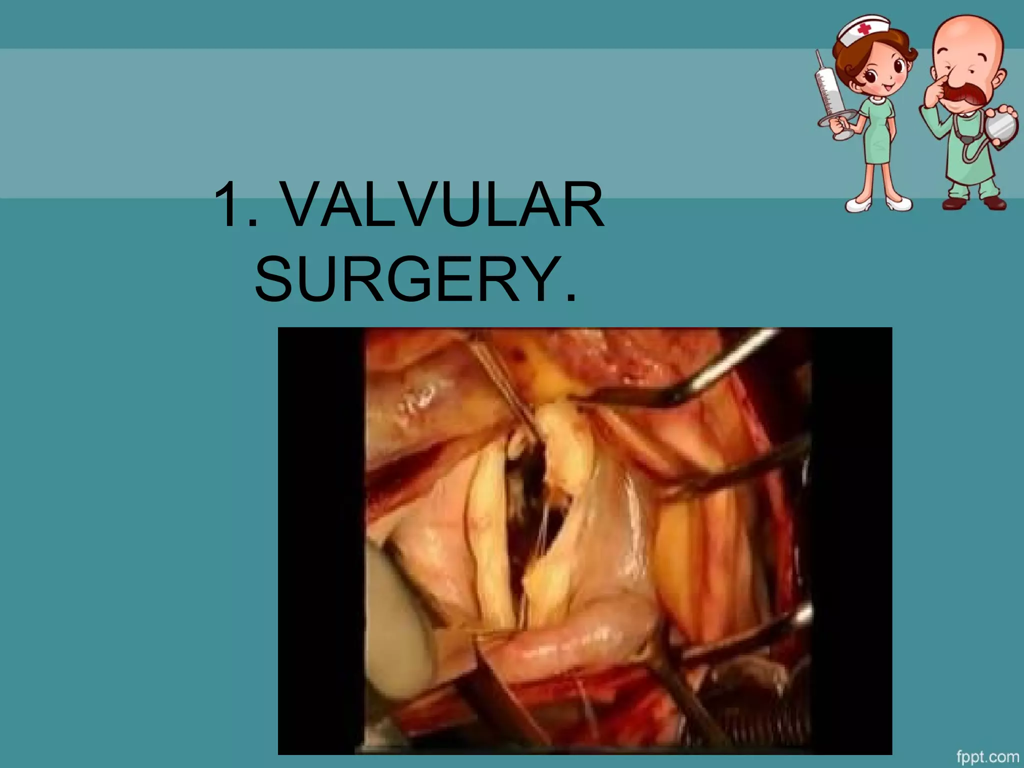 Cardiac surgeries | PPT