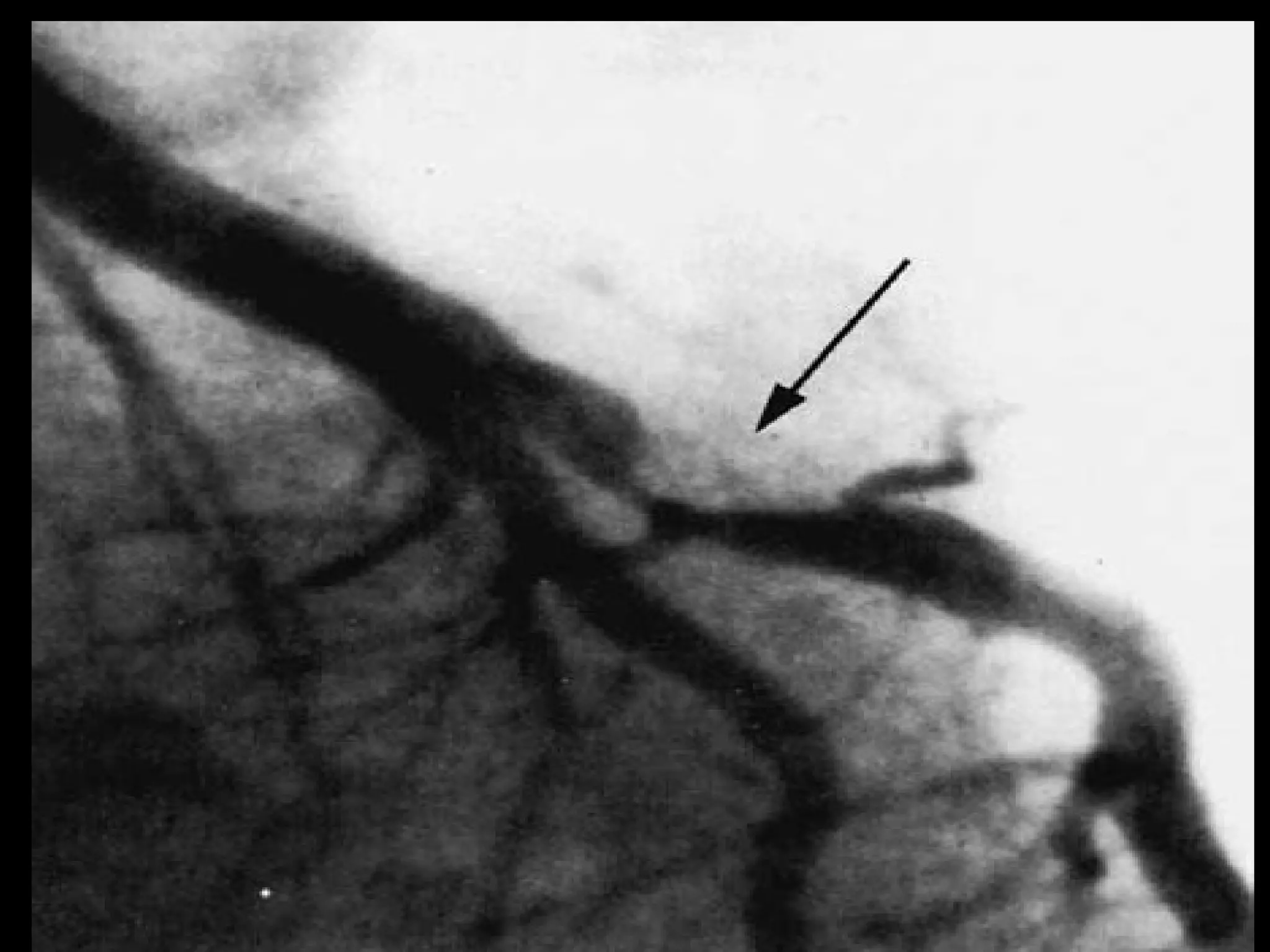 Cardiac surgery and ptca | PPT