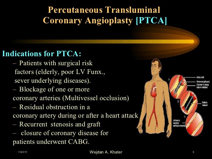 Cardiac surgery and ptca
