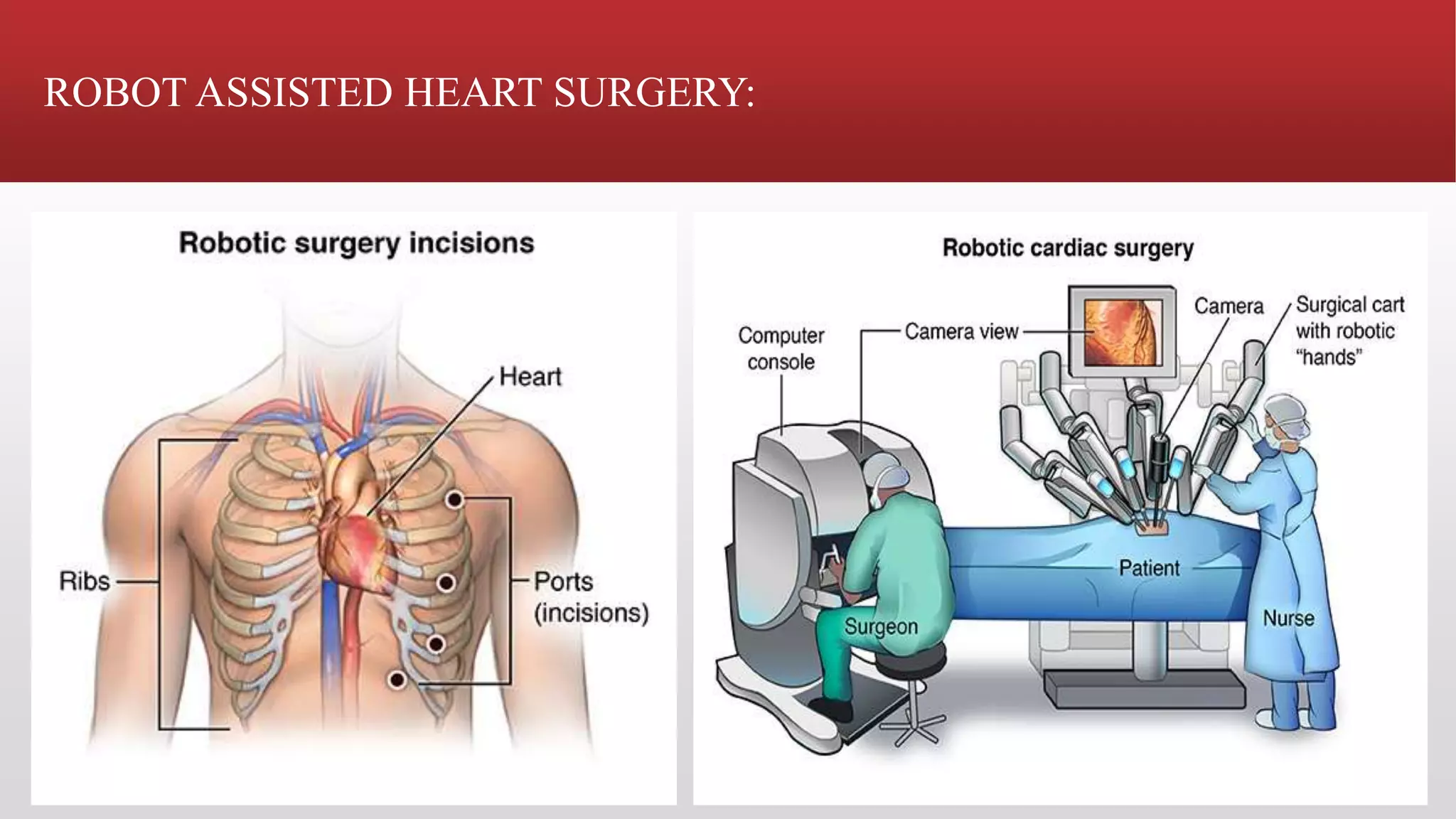 Cardiac surgery | PPTX