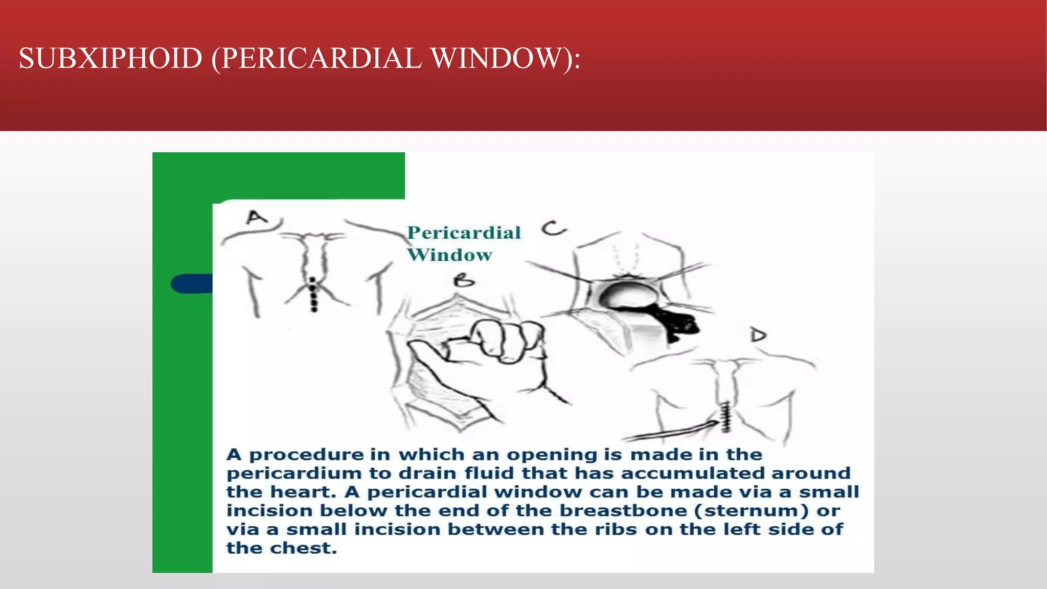 Cardiac surgery | PPTX