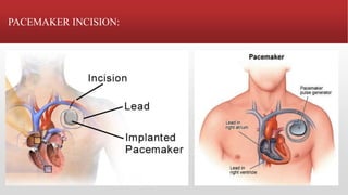 Cardiac surgery | PPTX