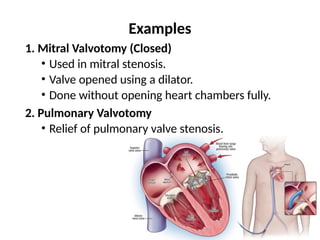 Cardiac Surgery introduction, Types and Physiotherapy Implications | PPTX