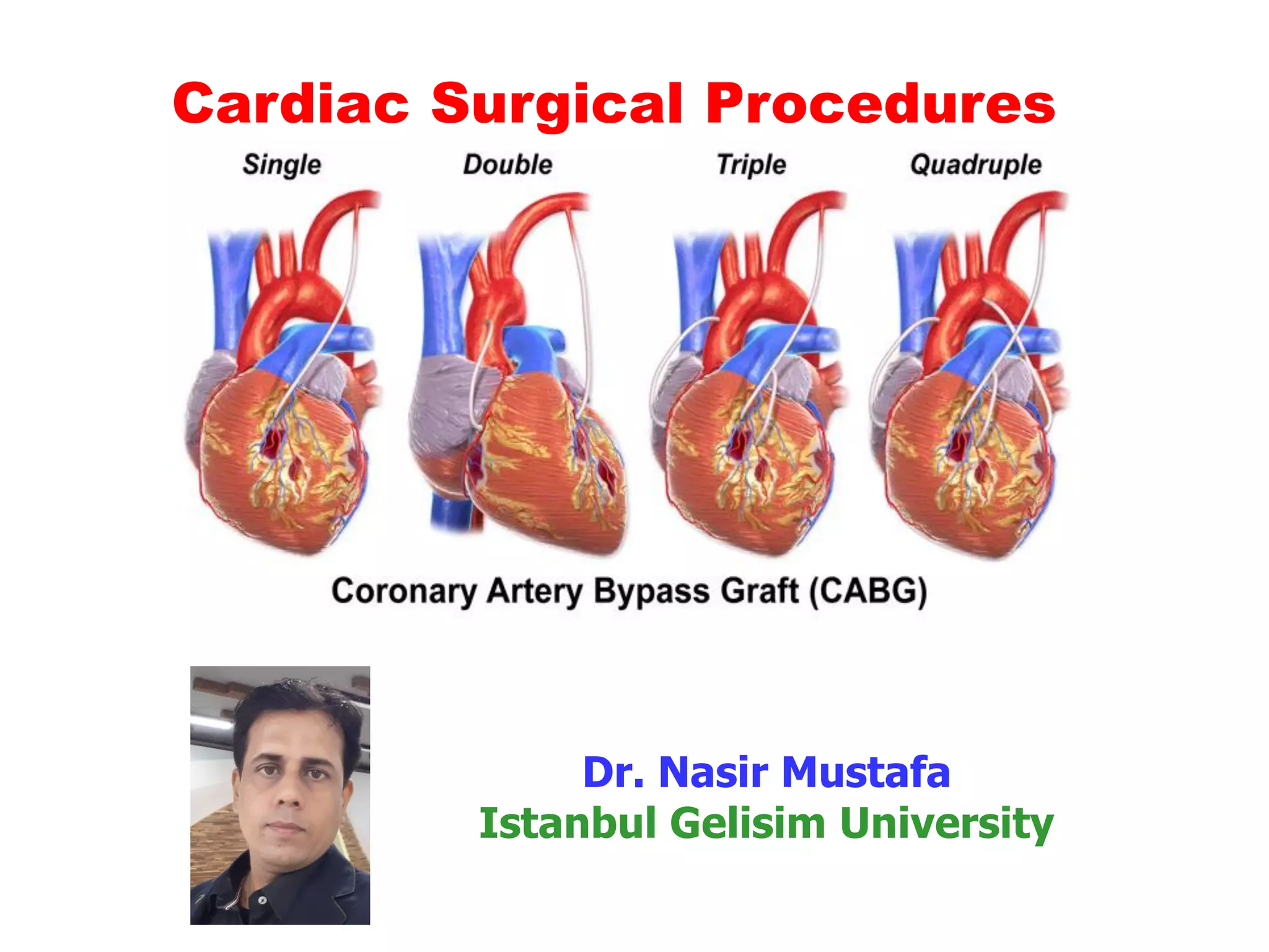 Cardiac surgical procedures | PDF