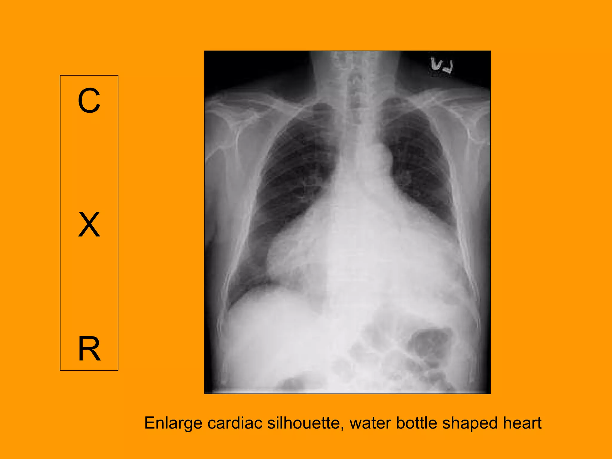 Cardiac Tamponade | PPT