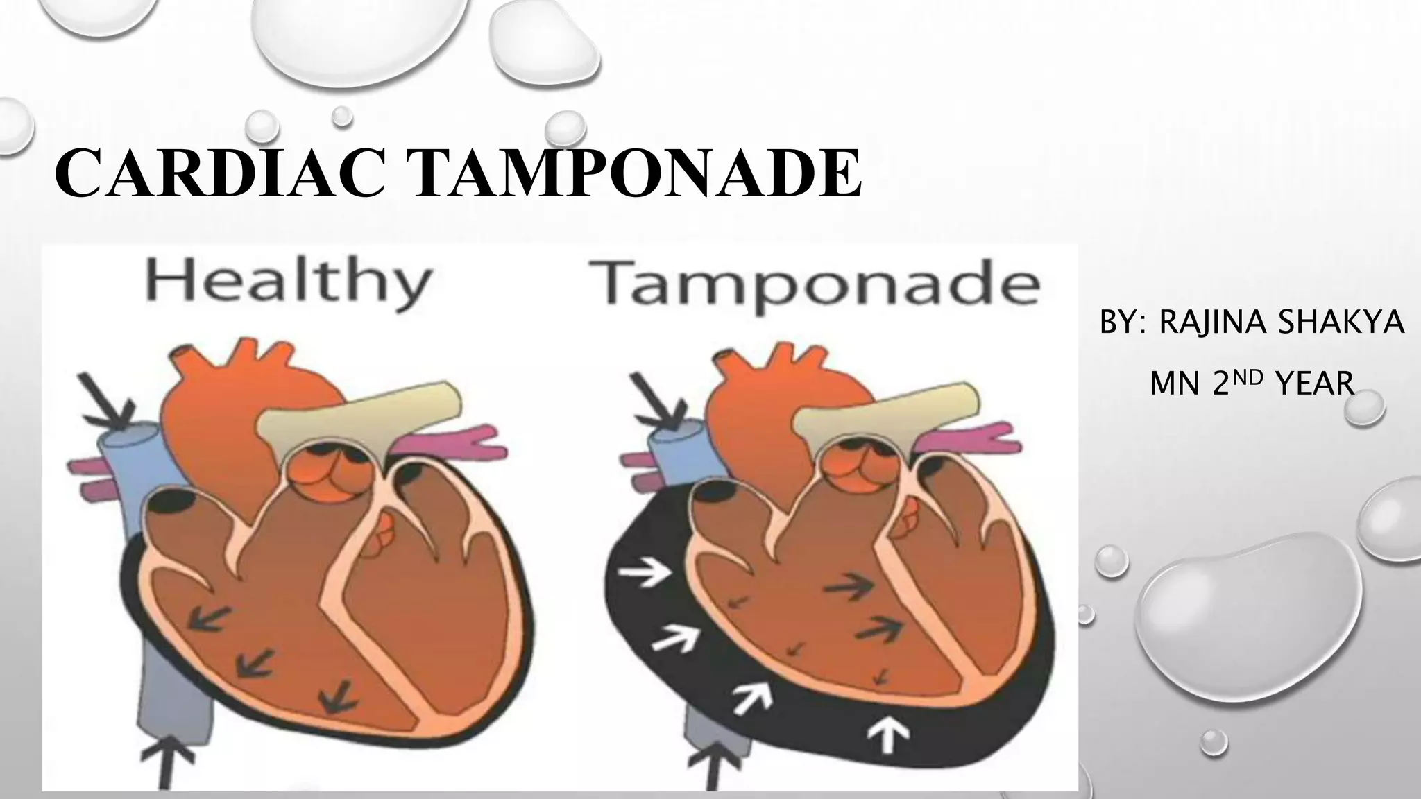 Cardiac tamponade | PPTX