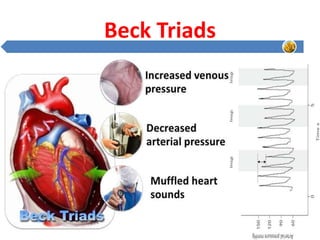 Cardiac tamponade | PPTX