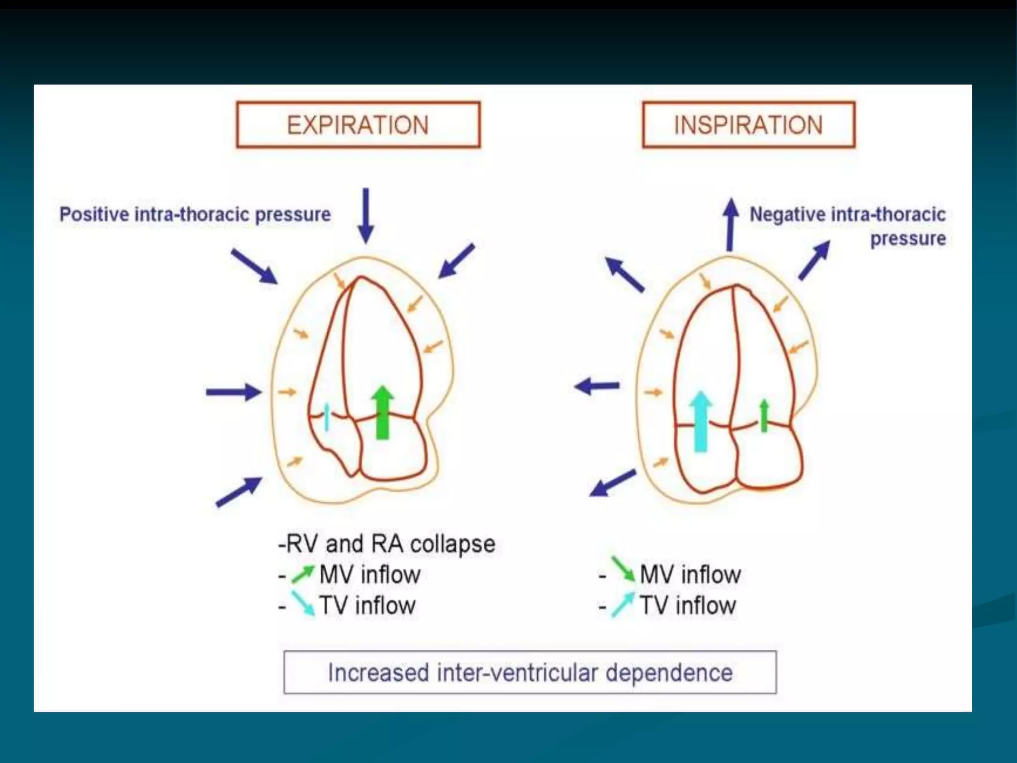 Cardiac tamponade | PPTX