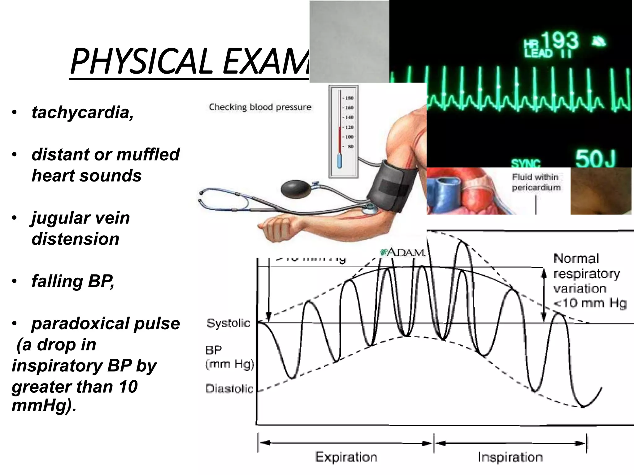 Cardiac tamponade | PPTX | Heart and Cardiovascular Diseases | Diseases ...