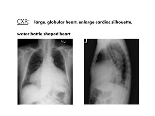 Cardiac tamponade | PPTX | Heart and Cardiovascular Diseases | Diseases ...