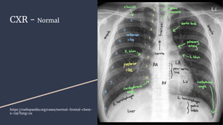 Cardiac tamponade | PPTX