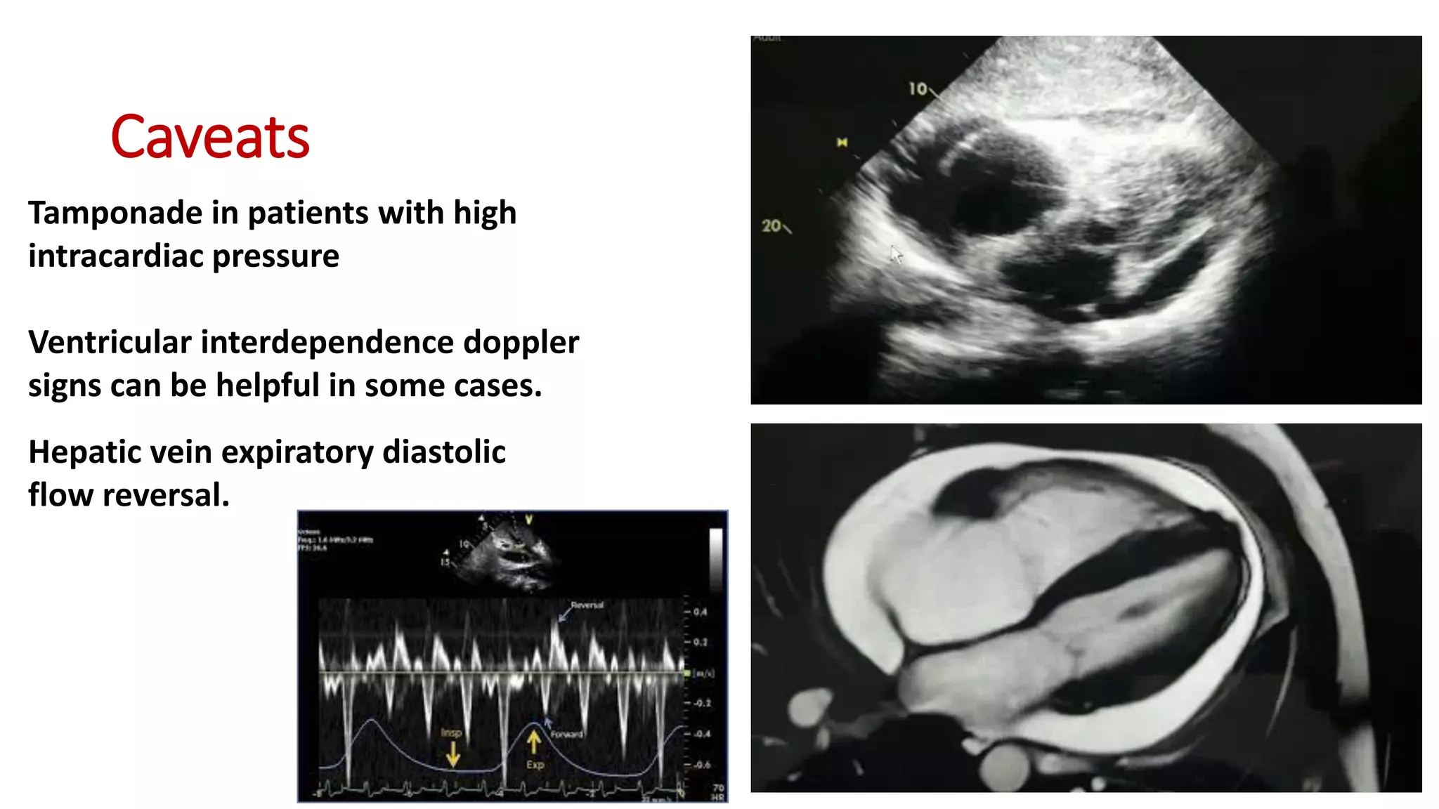 Cardiac Tamponade.pdf