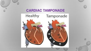 Powerpoint Presentation About Cardiac Tamponade Pptx