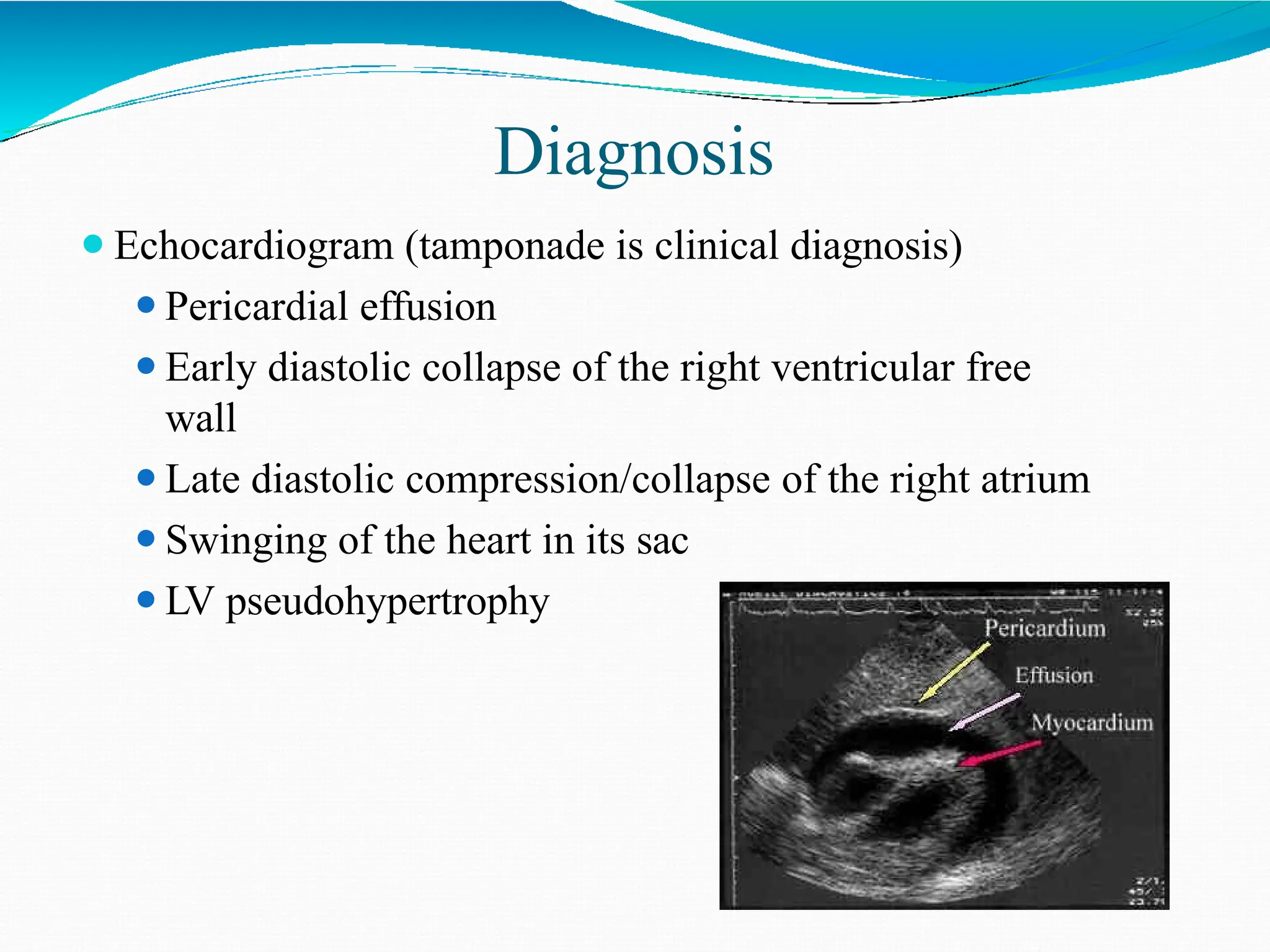 Cardiac Tamponade. presentation in detail | PPTX