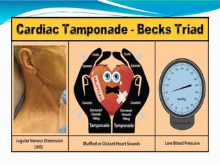 Cardiac Tamponade. presentation in detail | PPTX