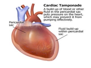 cardiac tamponade.heart disease which affects outer and inner | PPTX