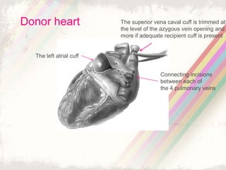 Cardiac transplantation | PPTX
