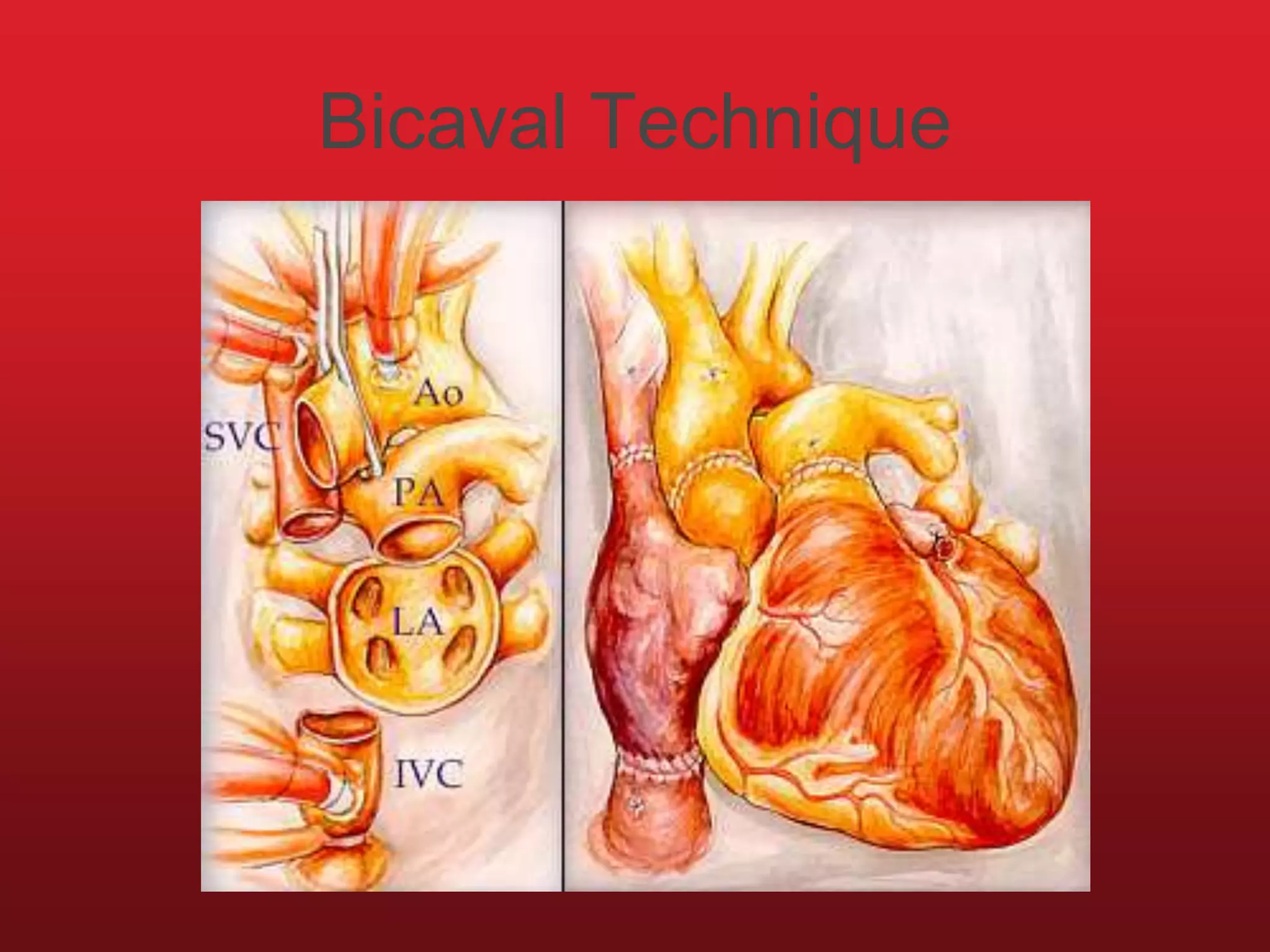 Cardiac transplant presentation | PPTX