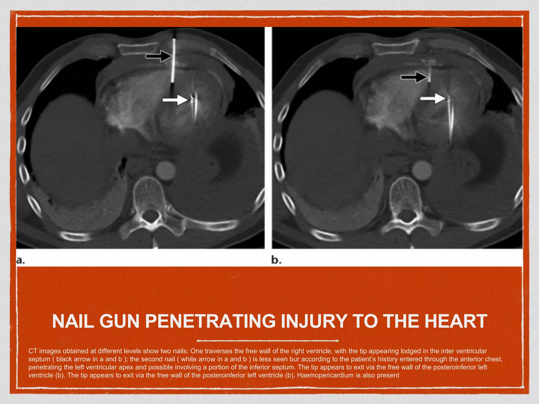 Cardiac trauma | PPTX