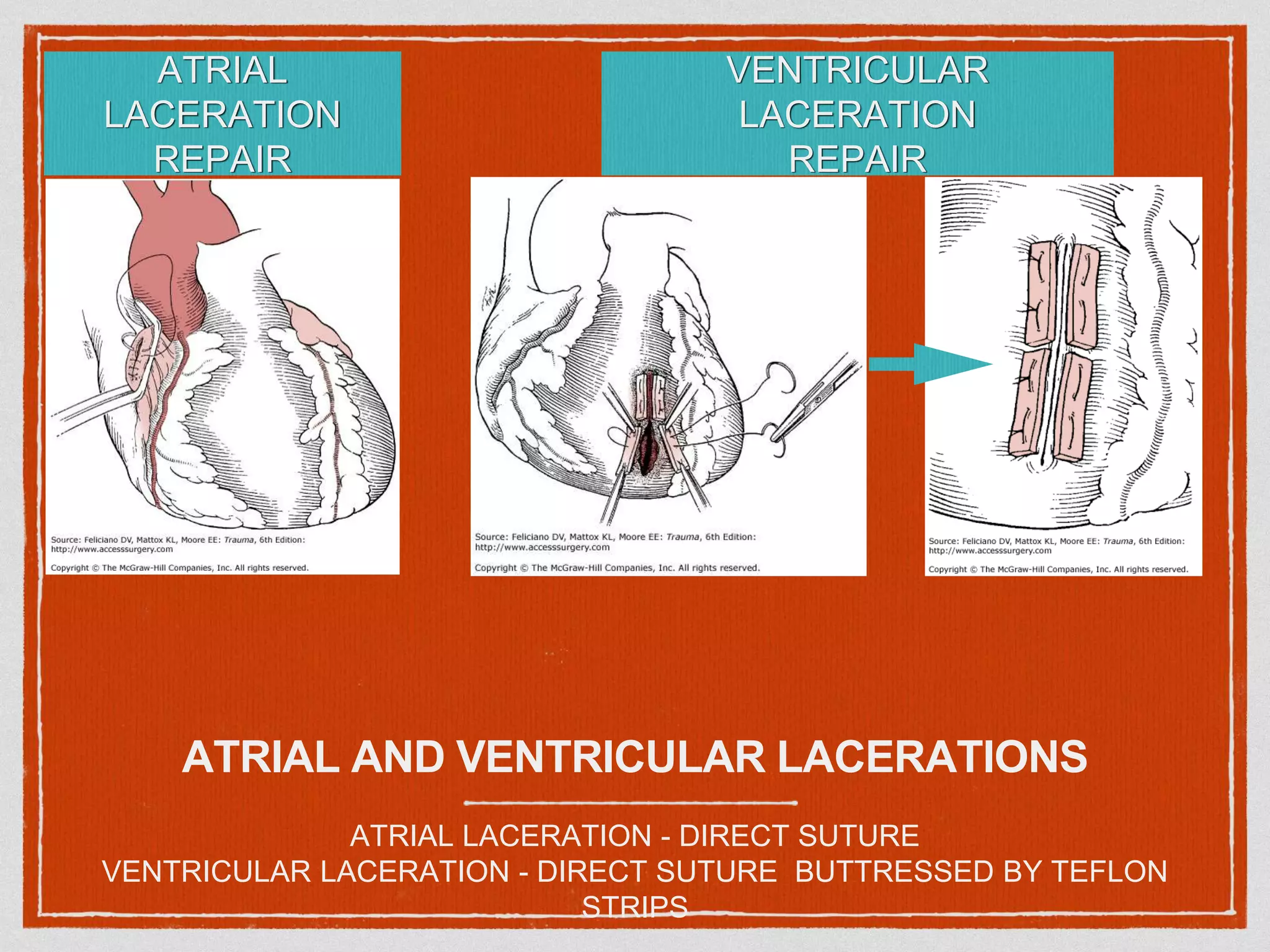 Cardiac trauma | PPTX