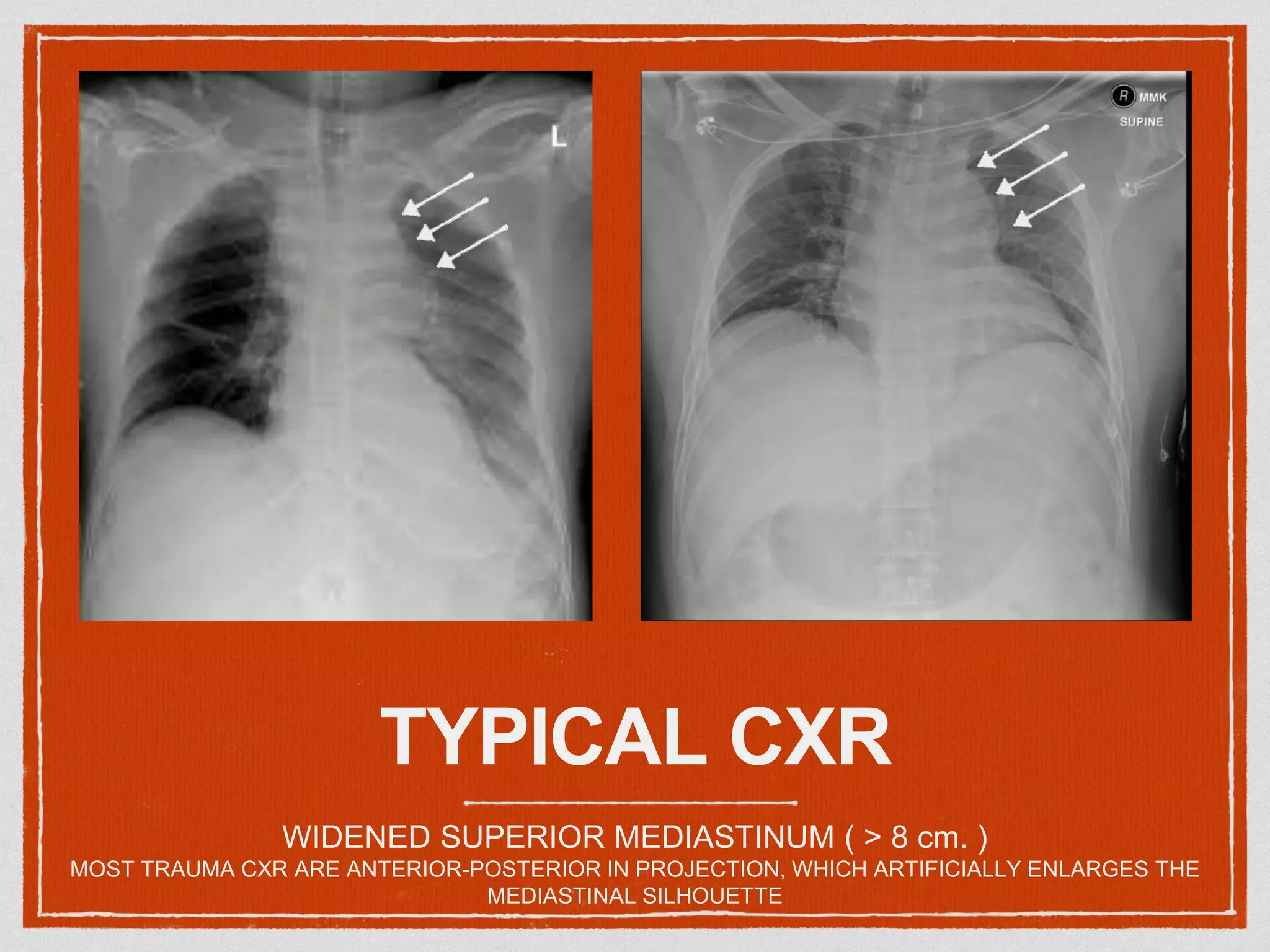 Cardiac trauma | PPTX