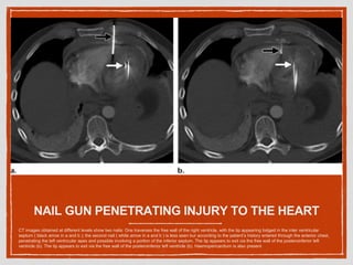 Cardiac trauma | PPTX