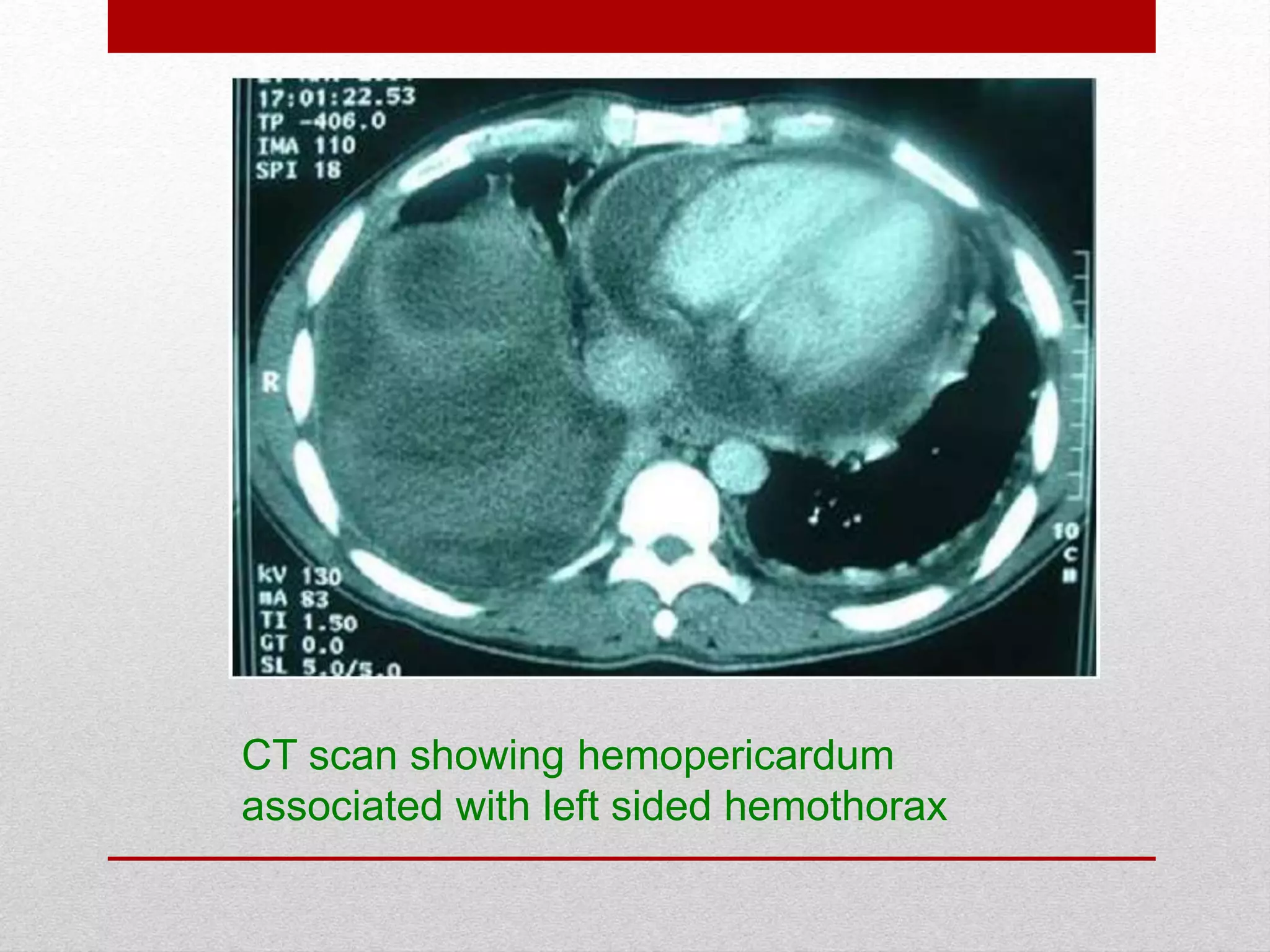 Cardiac trauma management | PPTX