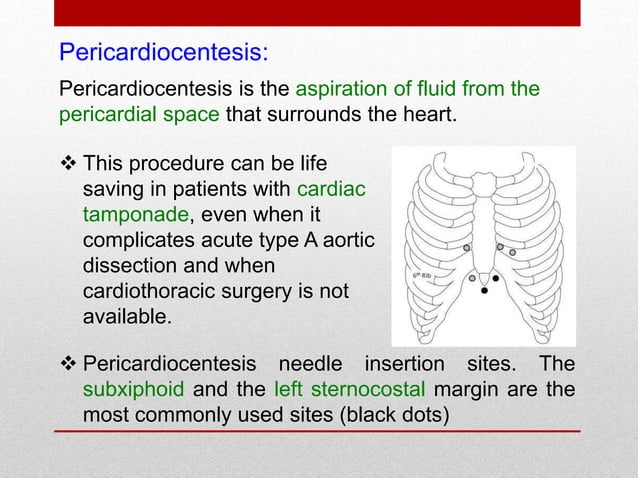 Cardiac trauma management | PPTX | Death, Injury, or Military Conflict | Sensitive Topics